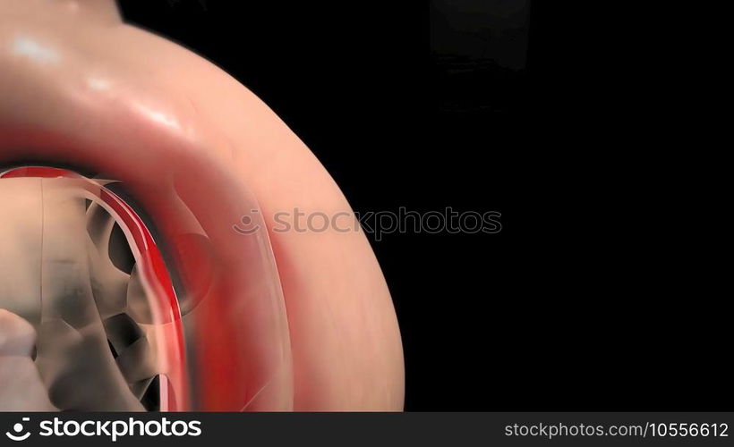 Aortic aneurysm and aortic dissection 3D Render. Aortic aneurysm and ...