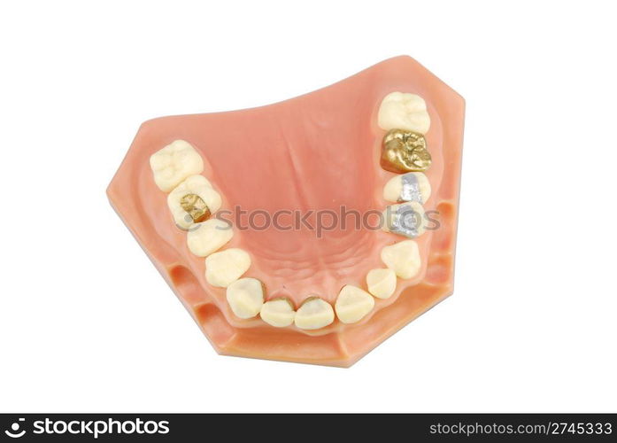 dental model showing different types of treatments gold crown ...