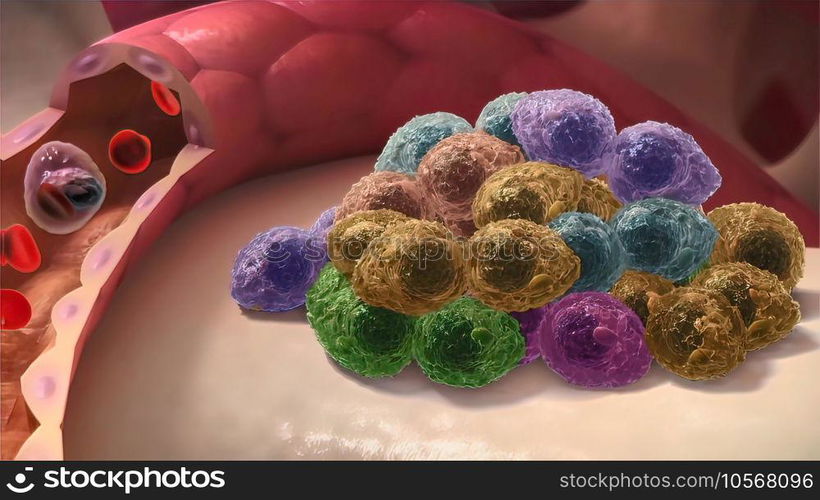 Multiple Myeloma, a type of cancer that consists of white blood cells ...