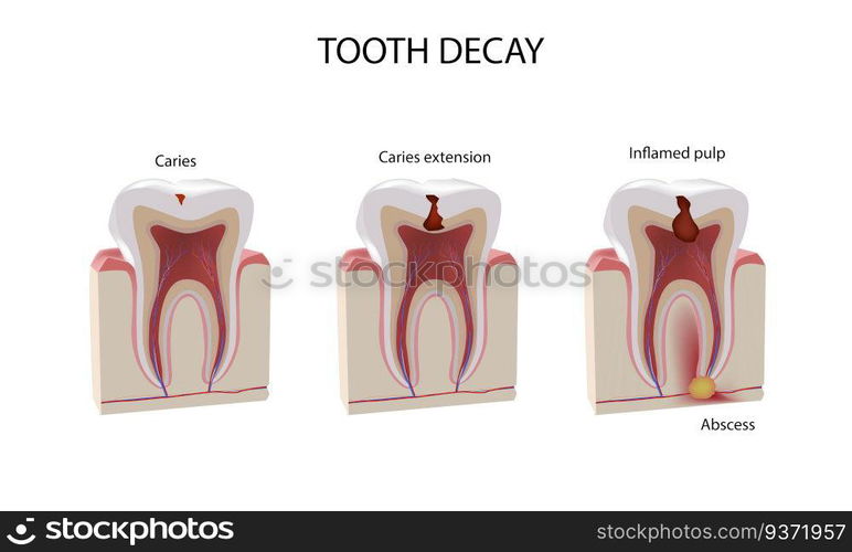 Tooth damage stages, realistic illustration, dental vector. Tooth ...
